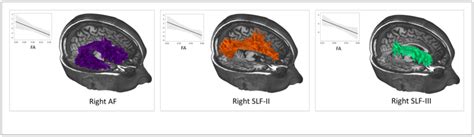 Significant Associations Between Tract Specific Dti Metrics And