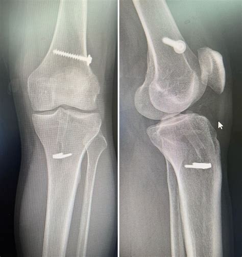 Hamza O On Linkedin Savetheknee