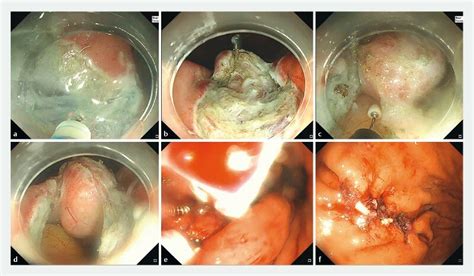 Endoscopic Full Thickness Resection Of Gastric Gist ½ Download