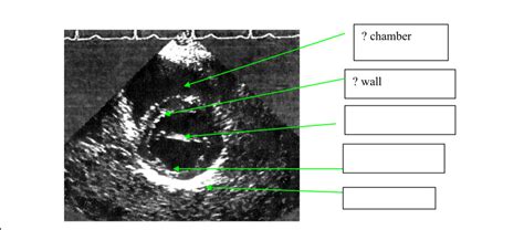 Psax Mitral Level Basal Diagram Quizlet