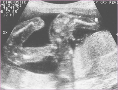 Multiple Gestation Clinical Characteristics And Management Clinical Tree