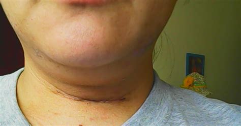 These And Beyond One Week Post Completion Thyroidectomy