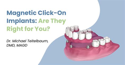 Magnetic Click On Implants Are They Right For You