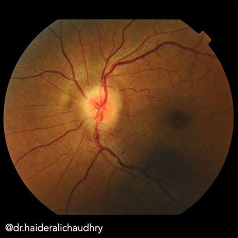 What Is Papilledema Grading System Frisen Scale Mohammed Alharbi