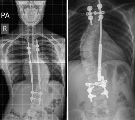 Growing Rods Scoliosis Procedure At Victor Fox Blog