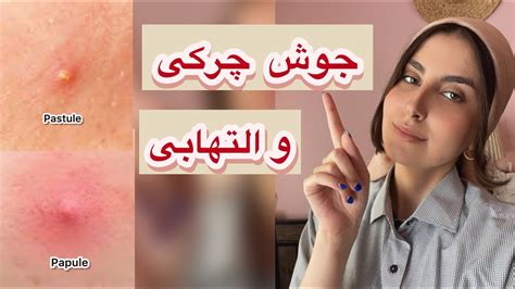 درمان جوش چرکی و التهابی اصولی Youtube