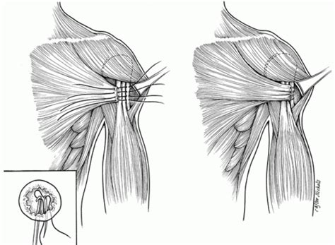 Pectoralis Tendon Tear Orthoinfo Aaos