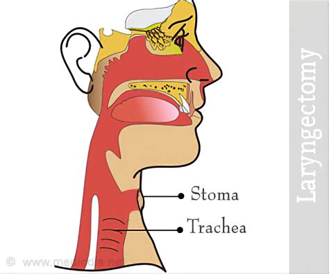 Laryngectomy Procedure Risks And Post Laryngectomy Therapy