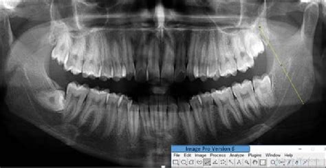 Measurement Of Coronoid Ramus Height Using The Measuring Tool