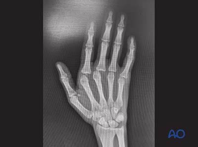 Dislocation And Fracture Dislocation Of The Metacarpophalangeal Joint