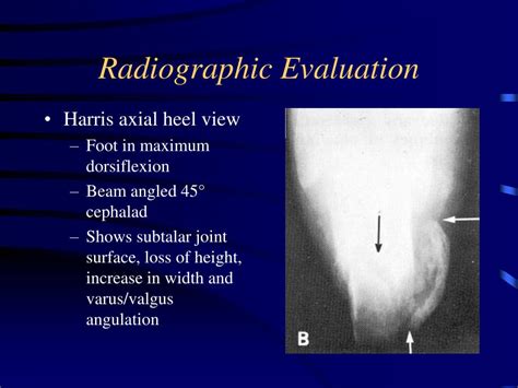 Ppt Calcaneus Fractures Powerpoint Presentation Free Download Id