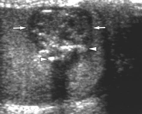 Sonographic And Mr Imaging Findings Of Testicular Epidermoid Cysts Ajr