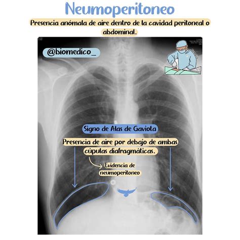 Biomedico 📌neumoperitoneo 🙌🏼🤔 👉🏼el Neumoperitoneo Es Facebook