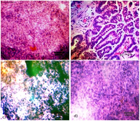 A Endometrial Tissue Biopsies From The Surface Resemble Those Of