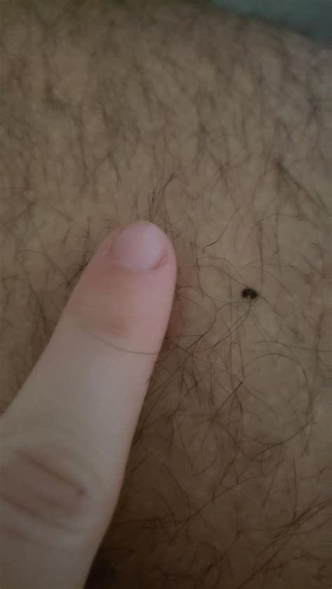 Is This Mole Normal Rdiagnoseme