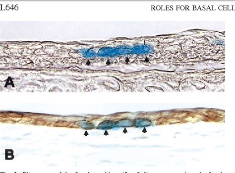 Basal Cell Hyperplasia Semantic Scholar