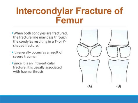 Pt Management Of Fractures Of Condyles Of Femur Pptx