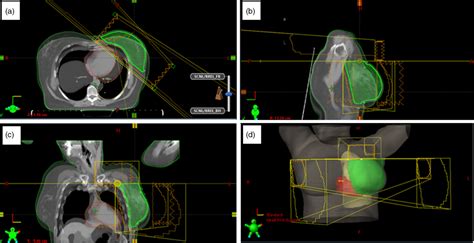 Dosimetric Evaluation Of 3 Andor 4 Field Radiation Therapy Of Breast