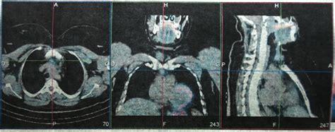 Sestamibi Scan In A Patient With Primary Hyperparathyroidism Showing Download Scientific