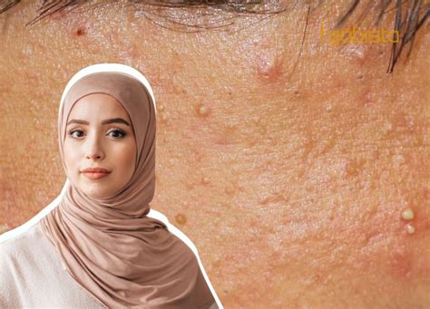 Punca Benjolan Di Muka Yang Anda Tidak Sedari Pakar Cadang Rawatan Terbaik