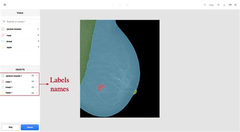 Breast Parts And Tumor Annotation Using Labelbox Tool Download