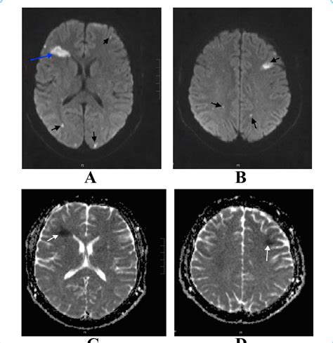 A And B MRI Brain Diffusion Weighted Images B Value 1000 Download Scientific Diagram