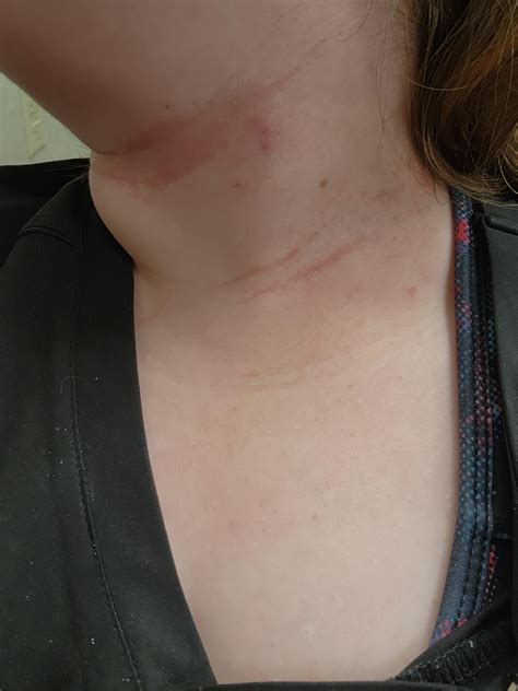 Whats With This Rash On My Neck Its Not Itchy Though I Do