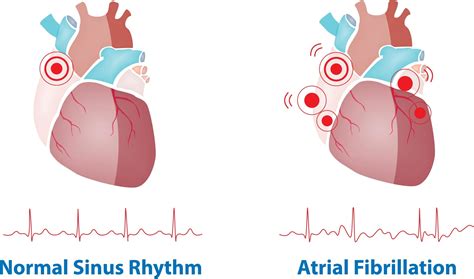 Atrial Fibrillation Treatment In Dubai Afib Treatment Uae