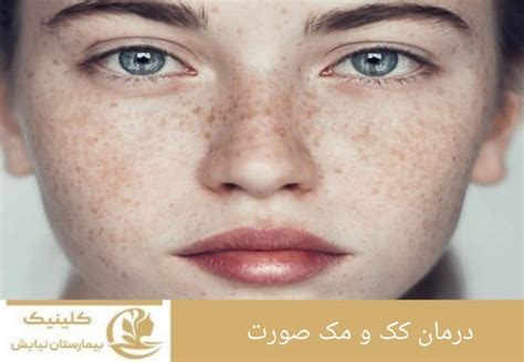 درمان کک‌ مک صورت لیزر کک‌ مک صورت کک و مک چیست؟