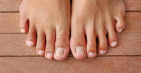 Early Stage Toenail Fungus How To Identify And Stop It Fast