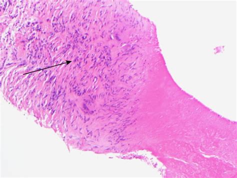 High Power Image Hande ×40 Showing Histiocytes Arrow Next To The