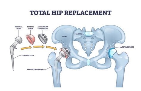 Best Hip Replacement Surgeon In Cheshire U K Prof Nikhil