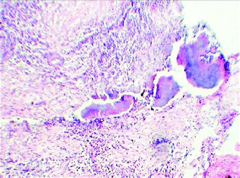 Actinomyces Pyogenes