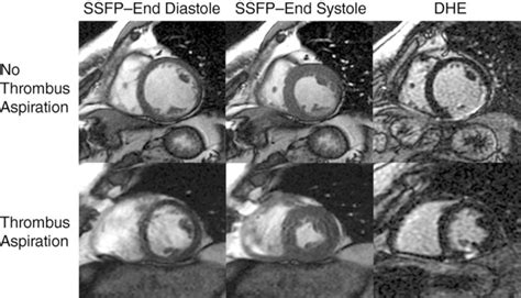Thrombus Aspiration During Primary Percutaneous Coronary Intervention