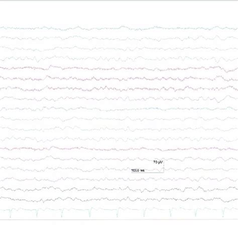 Eeg Two Months After Study End With Predominantly Theta Activity