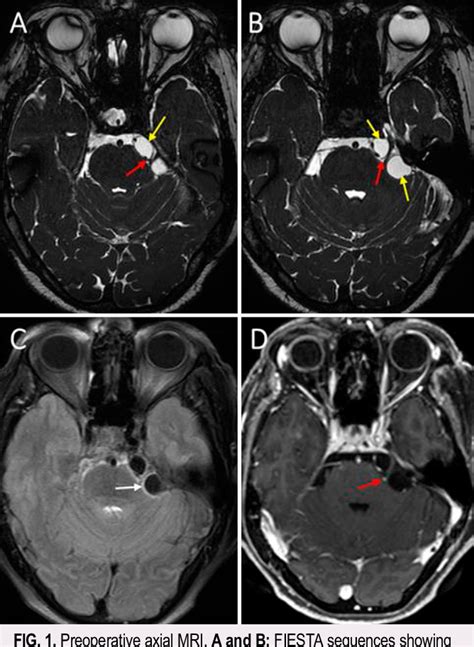 Figure 1 From Trigeminal Neuralgia Secondary To Vascular Compression And Neurocysticercosis