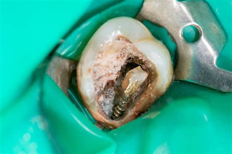 Human Tooth Close Up Macro Endodontics Treatment Of Canals And Pulp Of