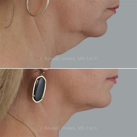 Acculift Rf In Jackson Ms Neck Liposuction Skin Tightening Faces