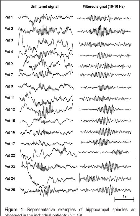 Figure 1 From Interictal Hippocampal Spiking Influences The Occurrence
