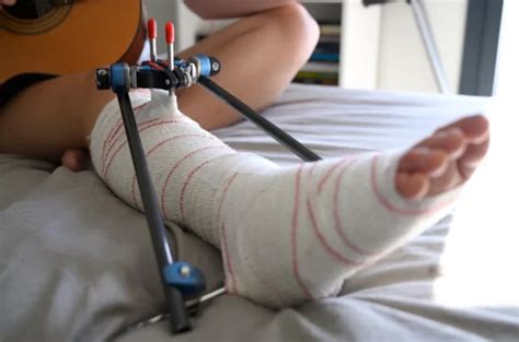 Fracture Management Dr Sukesh Reddy