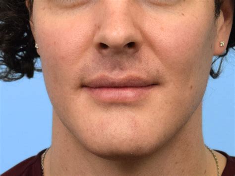 Chin Reduction Before And After Photos In Houston Tx Face Forward