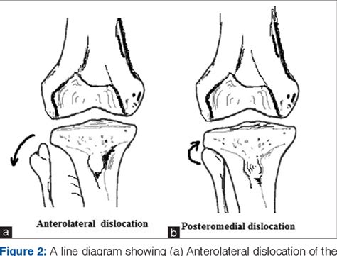 Proximal Tibiofibular Joint