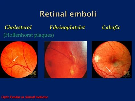 Cholesterol Plaque In Retinal Artery At Antonio Talbert Blog