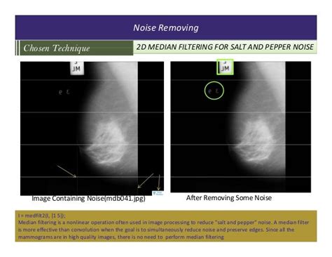 Microcalcification Identification In Digital Mammogram For Early Dete