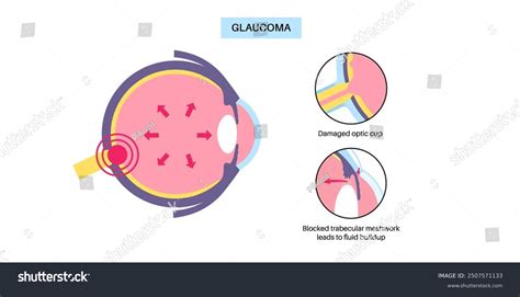Glaucoma Poster Increased Intraocular Pressure Damaged Stock Vector