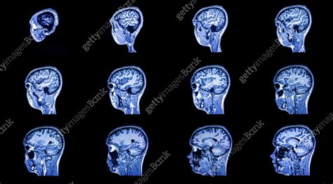 Magnetic Resonance Head Scan Sequence 이미지 1019468644 게티이미지뱅크