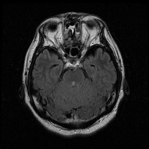 Ii Internuclear Ophthalmoplegia Inocanadian Neuro Ophthalmology Group