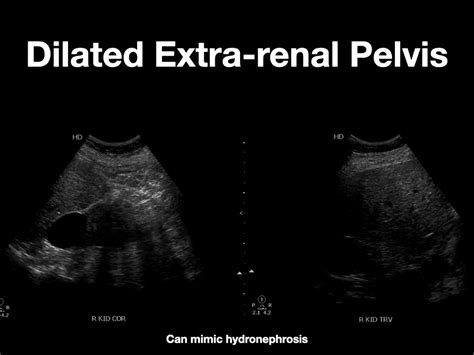 Extrarenal Pelvis