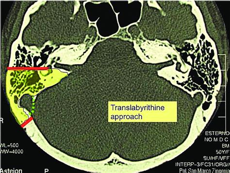 Representative CT Scan Of Temporal Bones Axial Demonstrating The Download Scientific Diagram