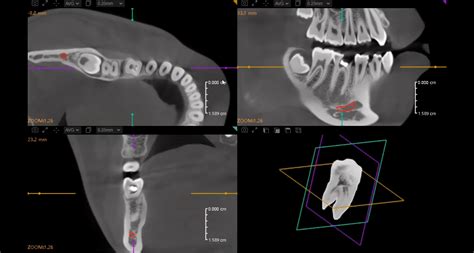 D50 Cbct